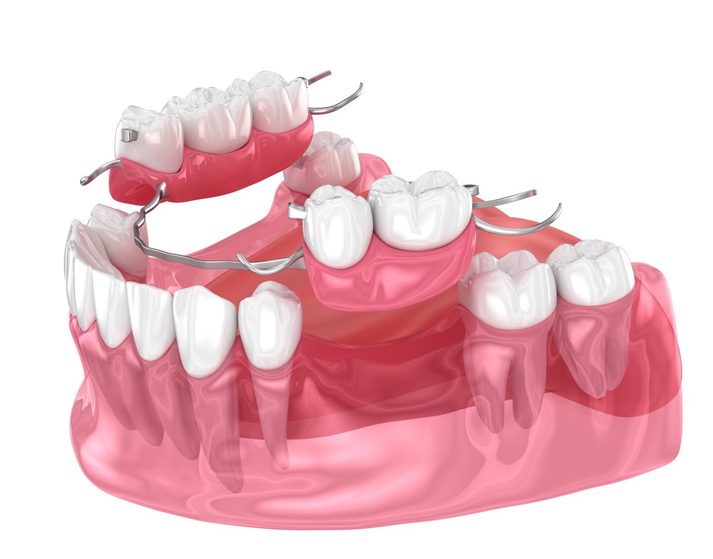 Dental Bridges Post-Op Instructions | JB Dentistry