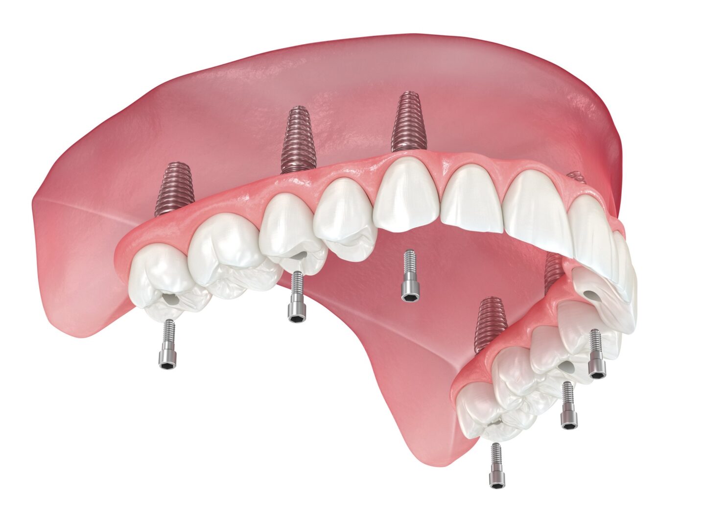Dental Implants Pompano Beach FL | JB Dentistry